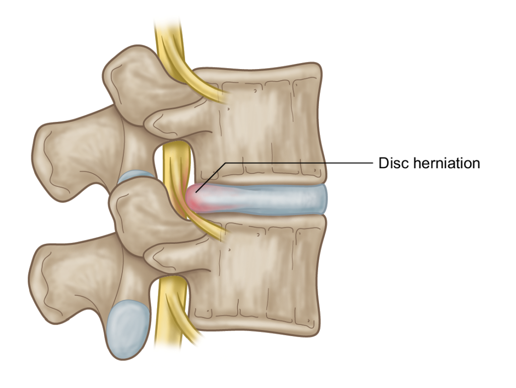 Dr. Djalma Amorim Jr. – Cirurgião de Coluna – Discos Intervertebrais ...
